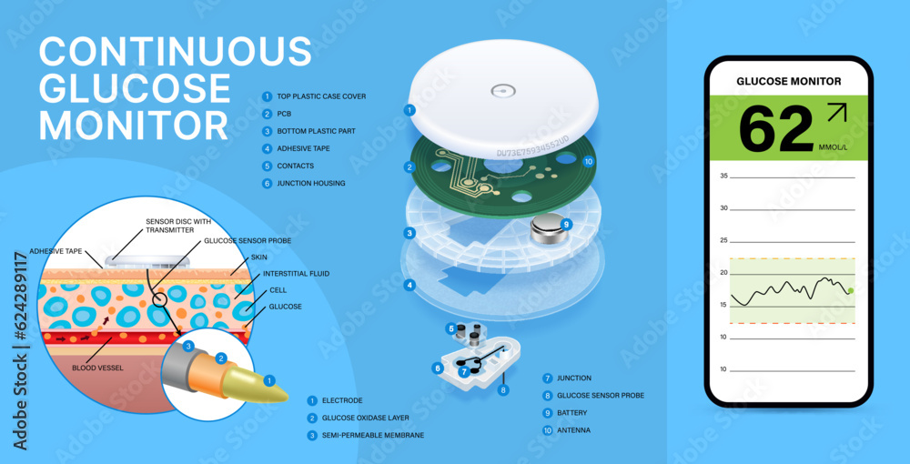 Fotografía Continuous glucose sugar monitor, Pro_Vector | Posters.es