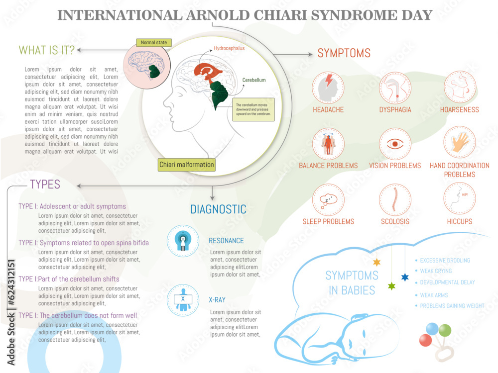 Poster Infographic of Arnold Chiari Syndrome, what it is, symptoms and ...