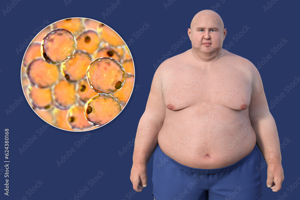 An overweight man with a close-up view of adipocytes, 3D illustration ...