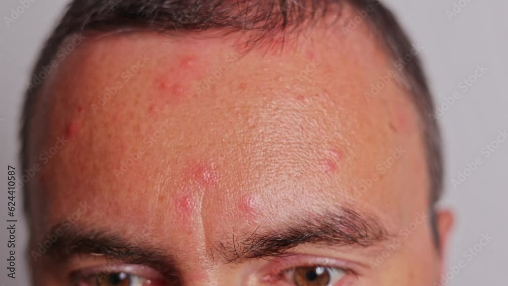 Man's forehead with acne, red spots, skin disease. Varicella or Herpes Zoster concept Stock ...