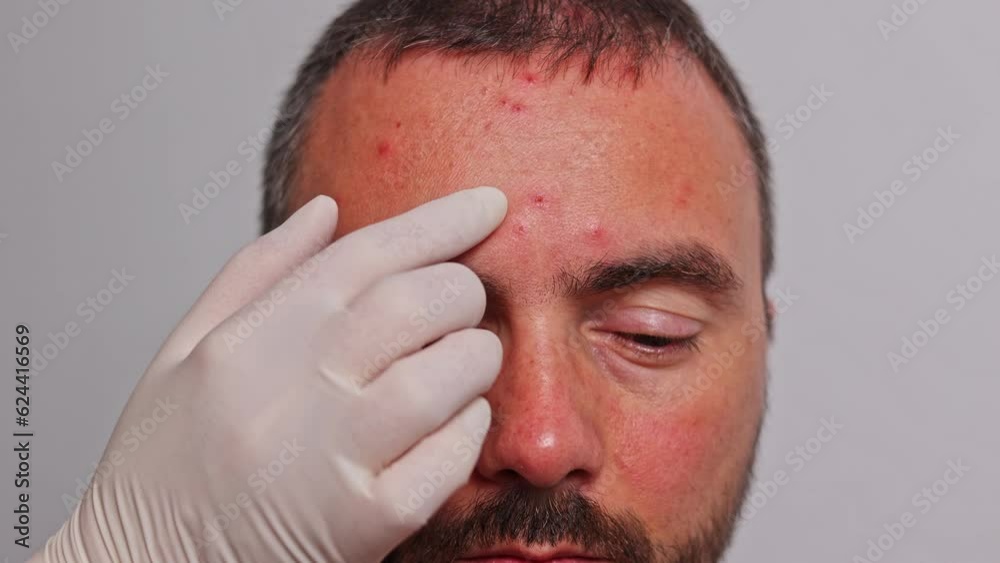 Man's forehead with acne, red spots, skin disease. Varicella or Herpes Zoster concept Stock ...