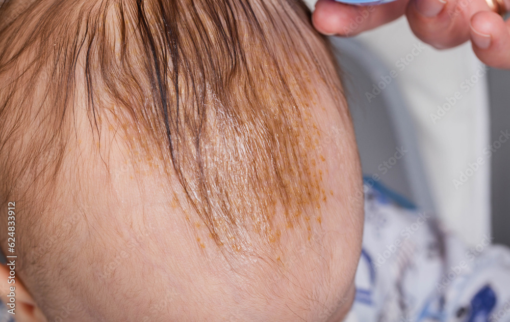 Applying a special cream and oil to the child's scalp to remove gneiss ...