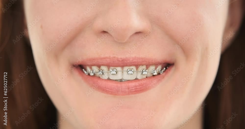Smile with orthodontic braces on teeth, mouth close up. Beautiful woman ...