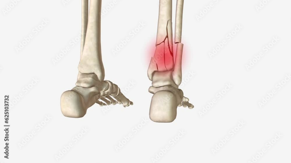 Distal tibia fracture is a fracture that involves the metaphyseal area ...