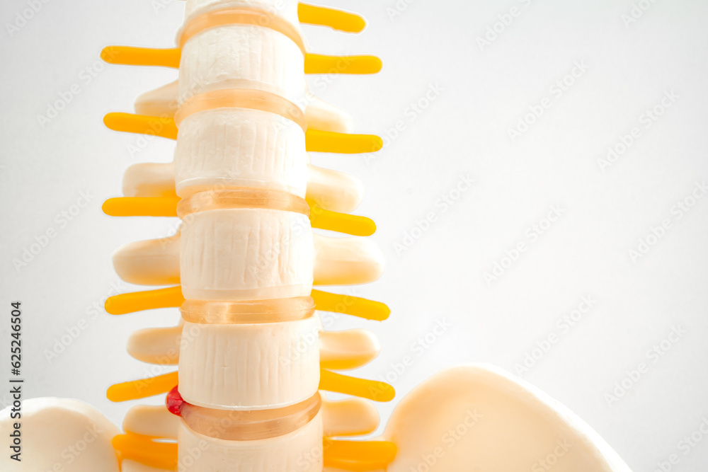 Lumbar spine displaced herniated disc fragment, spinal nerve and bone ...