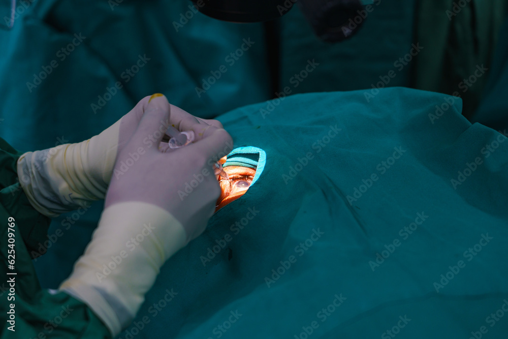 Doctor surgical operation eye lens replacement, intraocular lens ...