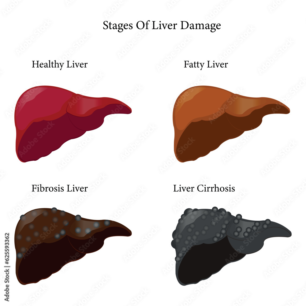 Stages of liver damage. Healthy, fatty, liver fibrosis and cirrhosis ...