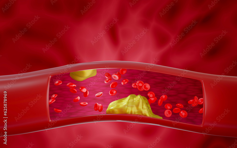medical simulation Blood clots or fat clots in the blood vessels ...