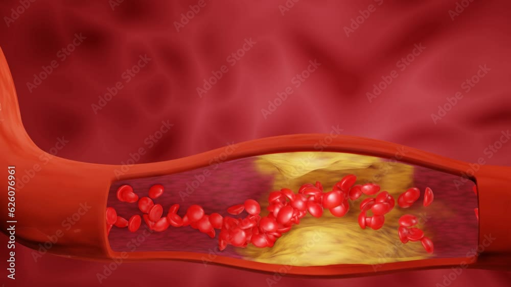 medical simulation Blood clots or fat clots in the blood vessels ...