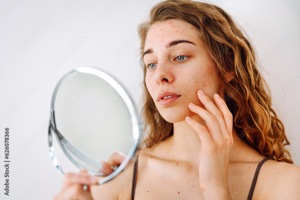 Foto de Skin problem. Curly woman touches red inflammations on her face ...