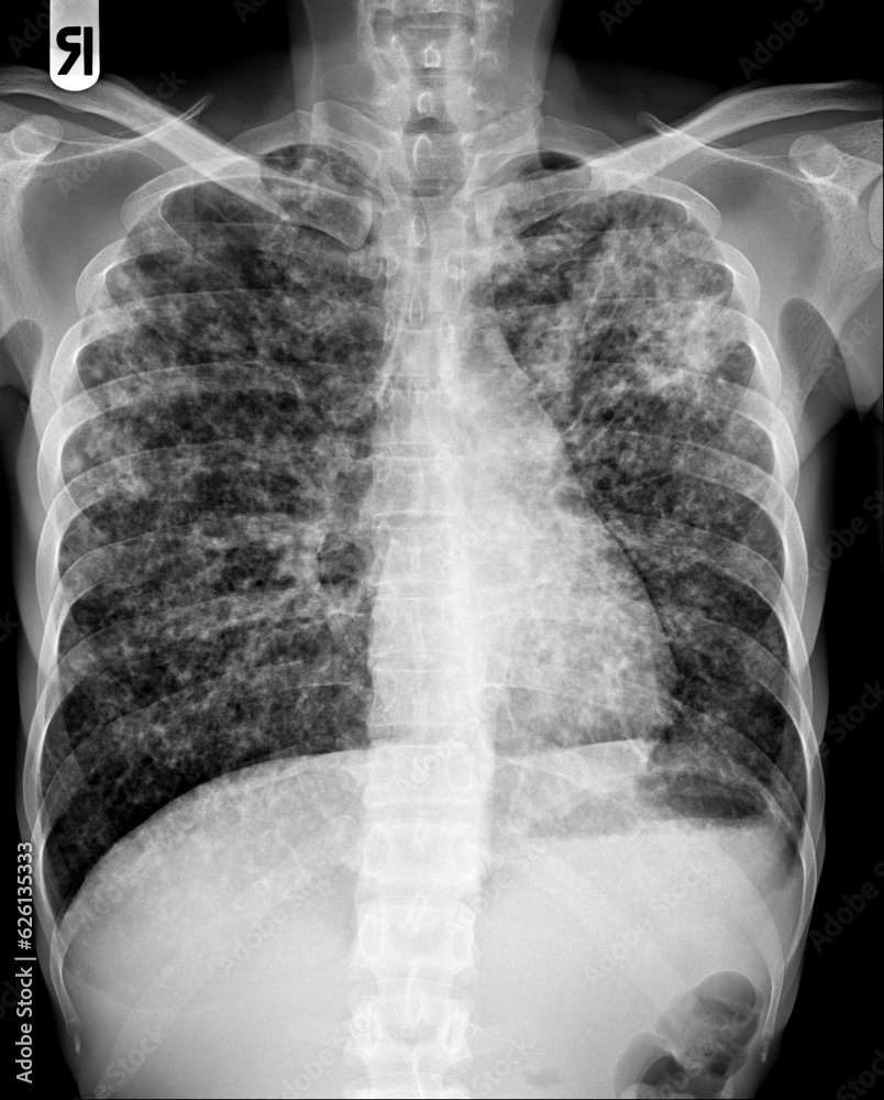Pulmonary Tuberculosis ( film chest x-ray : interstitial infiltrate ...