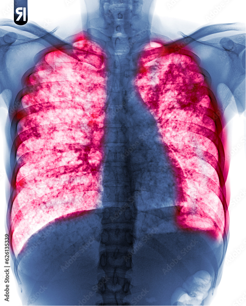 Pulmonary Tuberculosis ( film chest x-ray : interstitial infiltrate ...