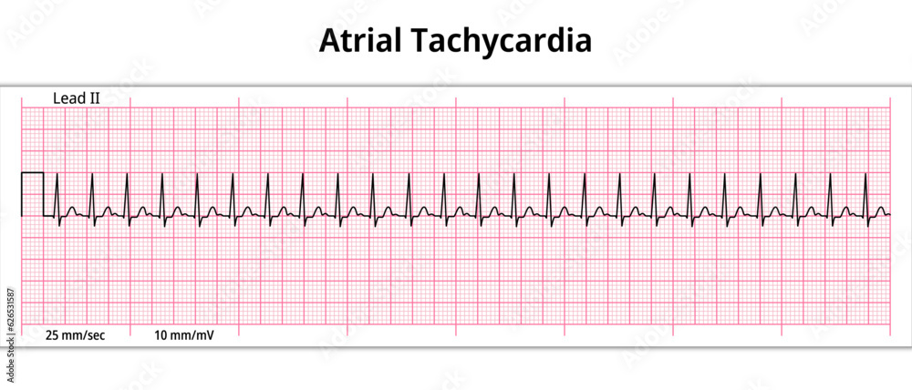 Photo & Art Print ECG Atrial Tachycardia - 8 Second ECG Paper ...