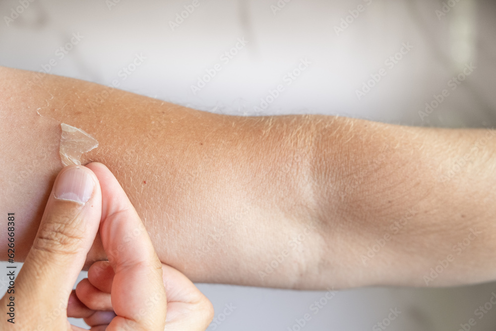 Exfoliation of the skin after sunburn. Man peeling off skin on his arm ...