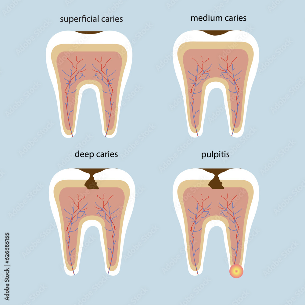 Set of teeth with stages of caries, tooth in section, tooth roots ...