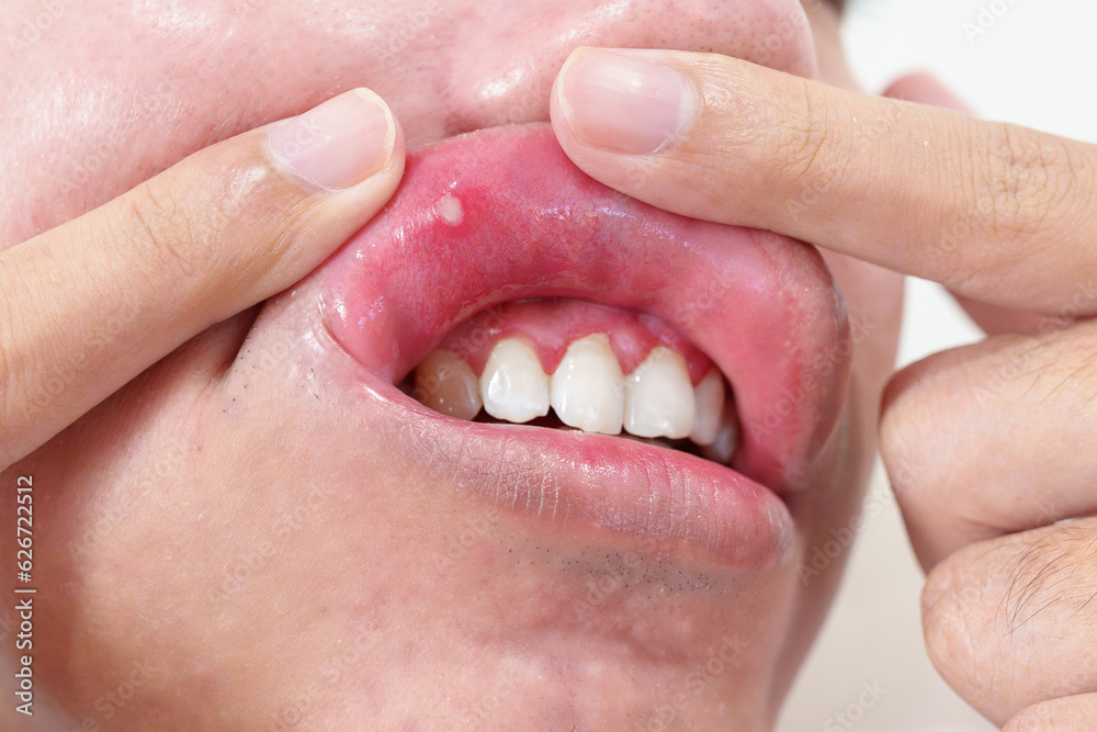 Mouth Ulcer Sore or Aphthous Stomatitis. Oral Health and Medical ...