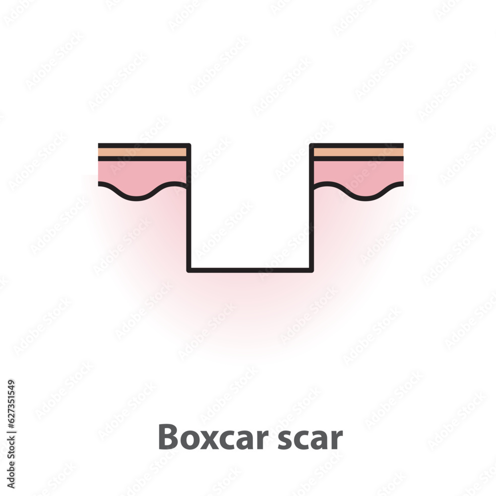 Boxcar scar, atrophic scar, type of acne scar on skin surface with ...