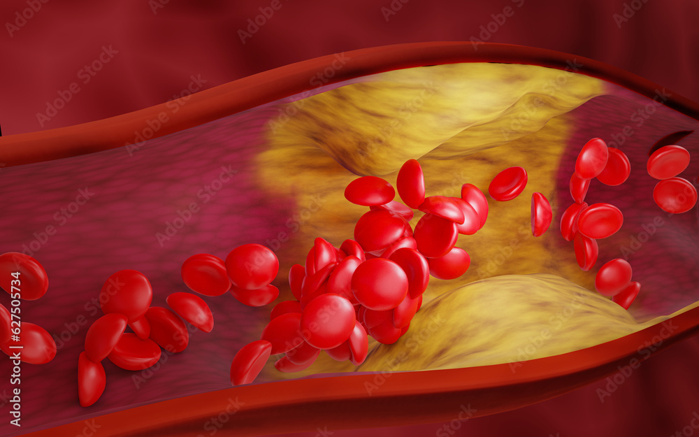 medical simulation Blood clots or fat clots in the blood vessels ...