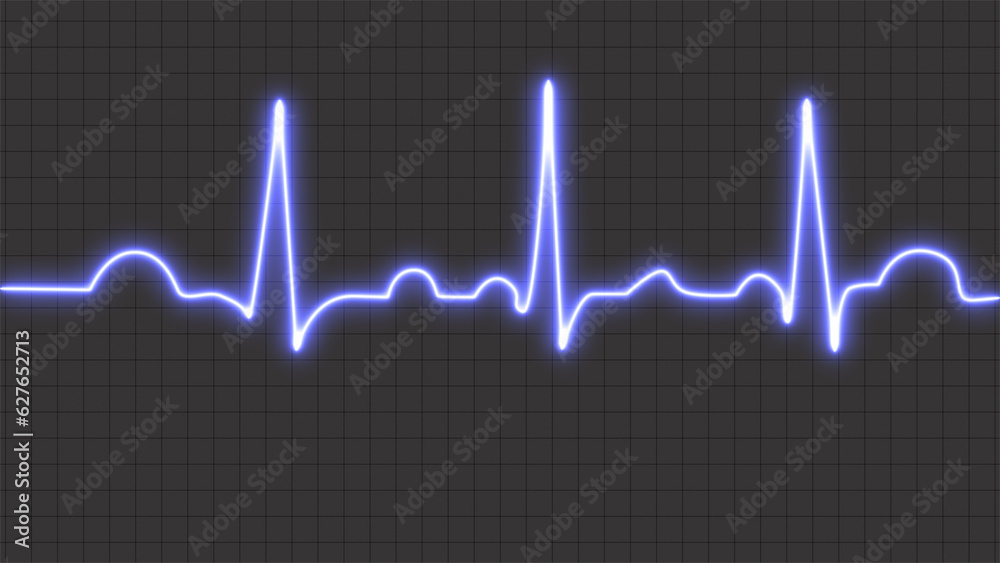 ECG that is normal, sinus rhythm that is normal, and genuine recording ...