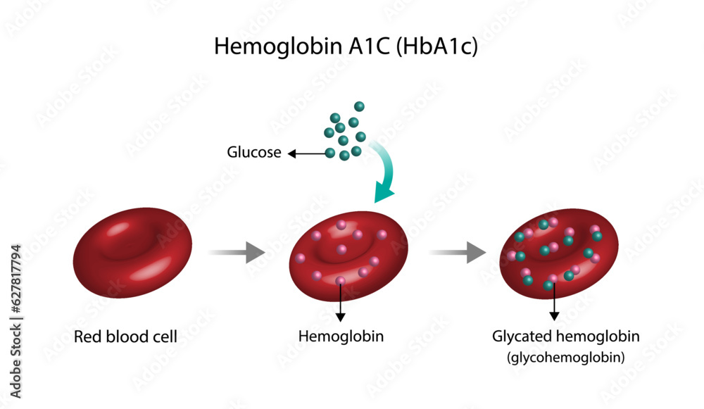 Hemoglobin A1C (HbA1c) blood , Glycated hemoglobin, HbA1c test ...