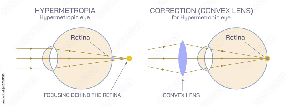 Difference between Hyperopia and myopia. The distant object becomes ...