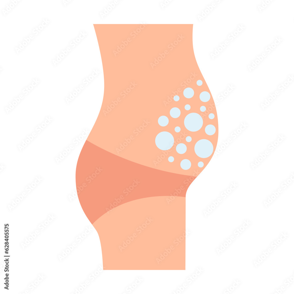 Protruding belly of human with bloating, flatulence, bubbles in tummy ...