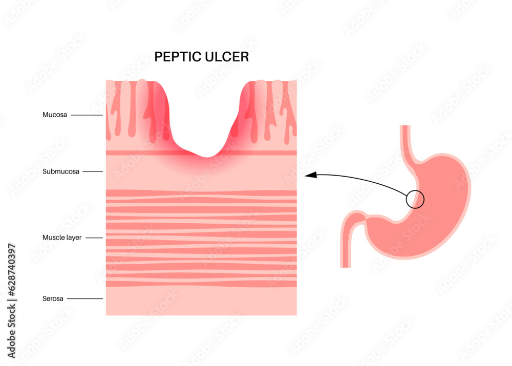 Peptic ulcer disease Stock Vector | Adobe Stock