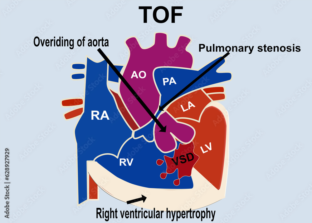 The picture show the structure of tetralogy of fallot that show the 4 ...