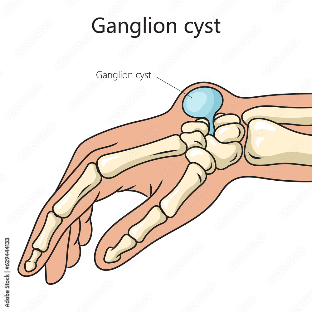 Ganglion cyst structure disease diagram schematic raster illustration ...