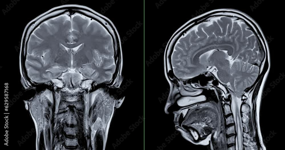 MRI Brain Coronal and sagittalT2W for diagnosis such as bleeding, swelling, tumors, infections ...