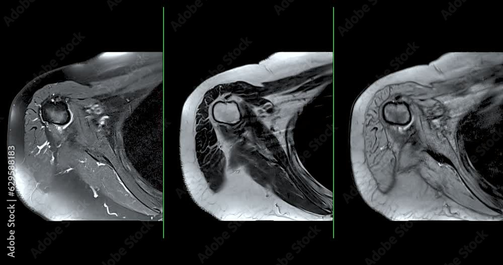 Magnetic Resonance Imaging or MRI of Shoulder Joint axial T1FS , T2 and Gredient for diagnostic ...