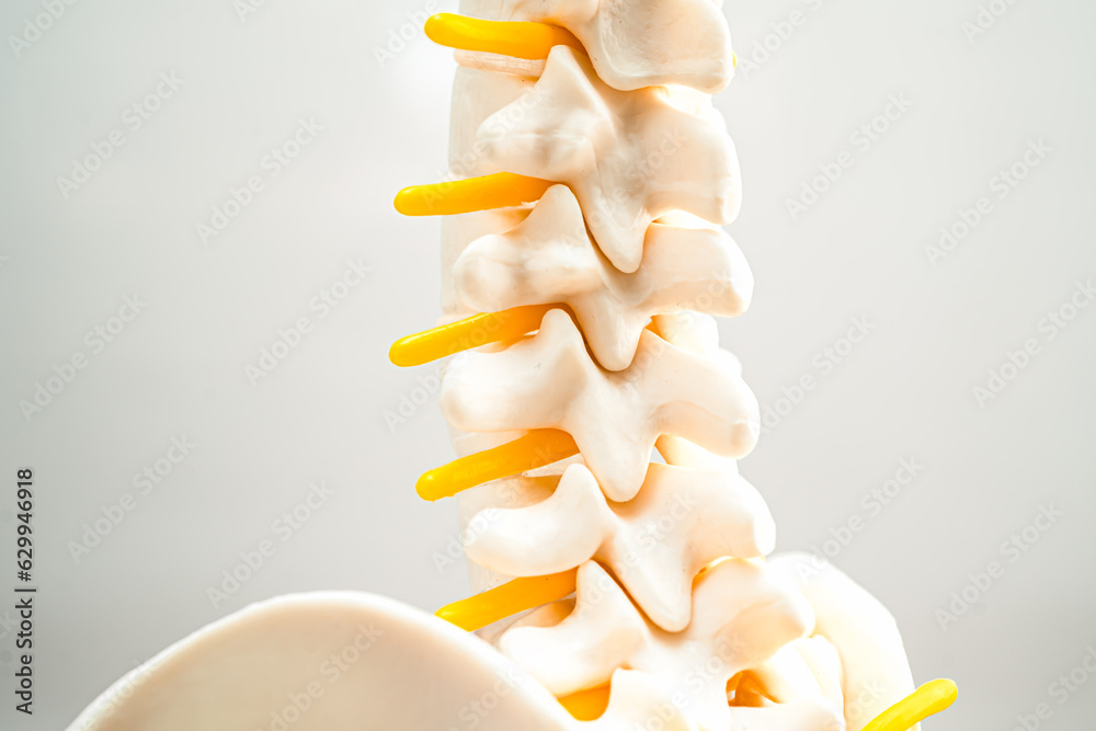 Lumbar spine displaced herniated disc fragment, spinal nerve and bone ...