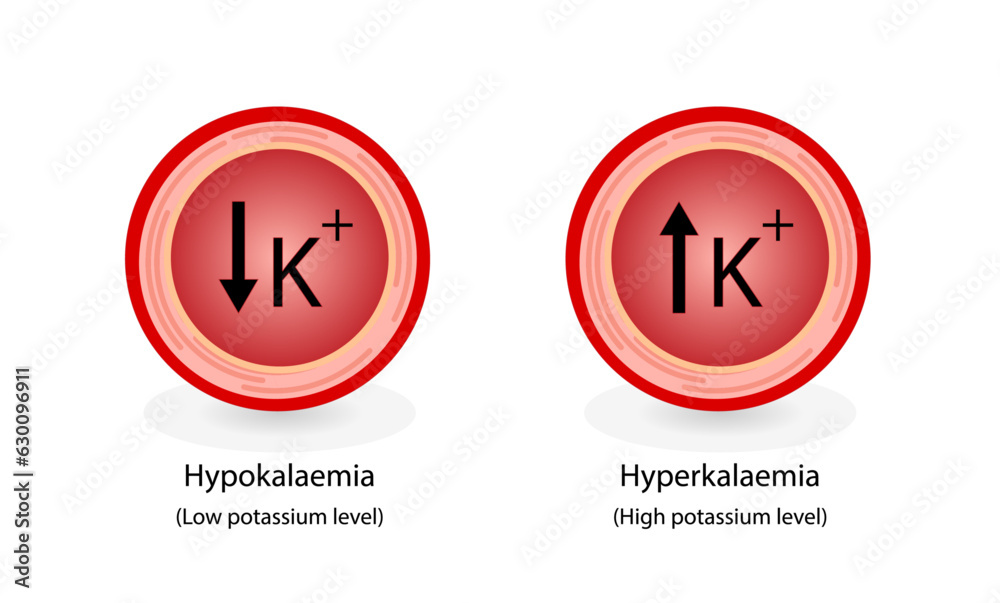 Hyperkalaemia, high plasma potassium level and Hypokalaemia, low plasma ...