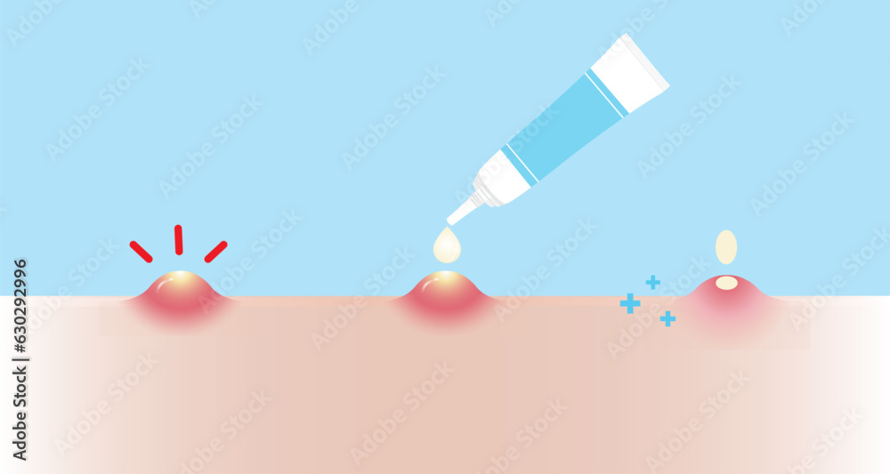 Direction for use acne pimple treatment for pustule vector illustration ...
