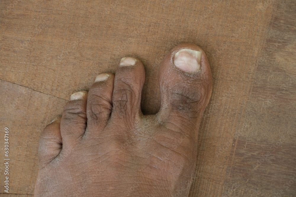 Psoriasis , Image of a man's feet on a wood background with fungal ...