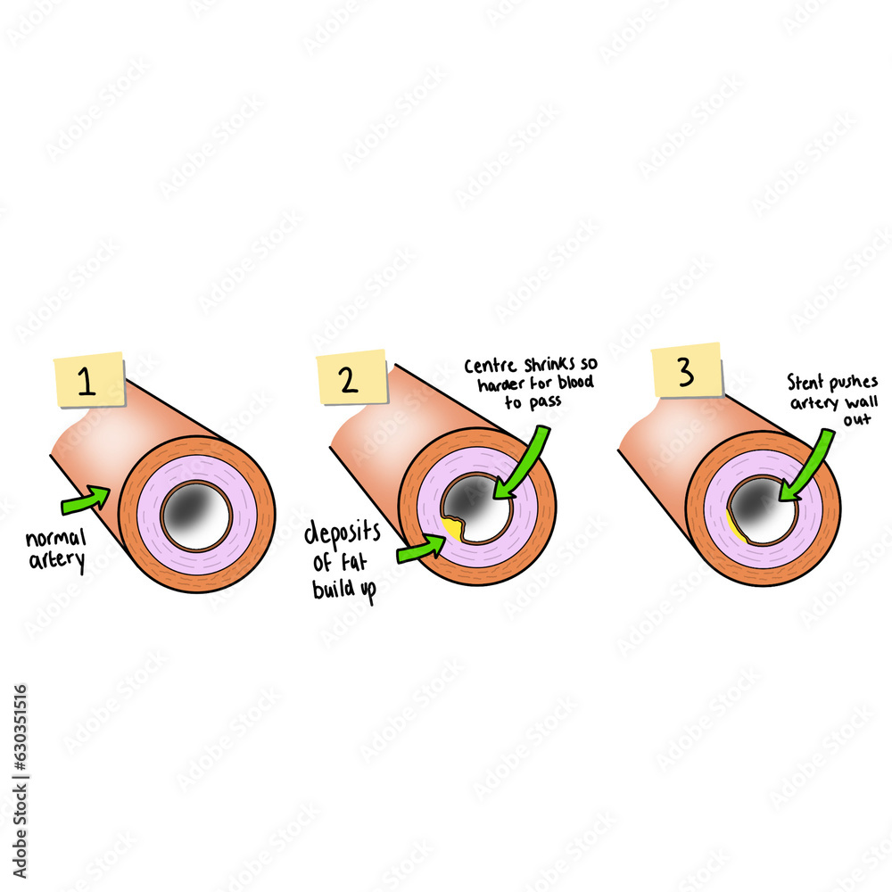 Stent Diagram Plaque Build Up Science Illustration Drawing Educational ...