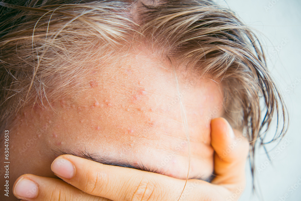 Acne on teenage boy forehead. Child is upset because of skin problems ...