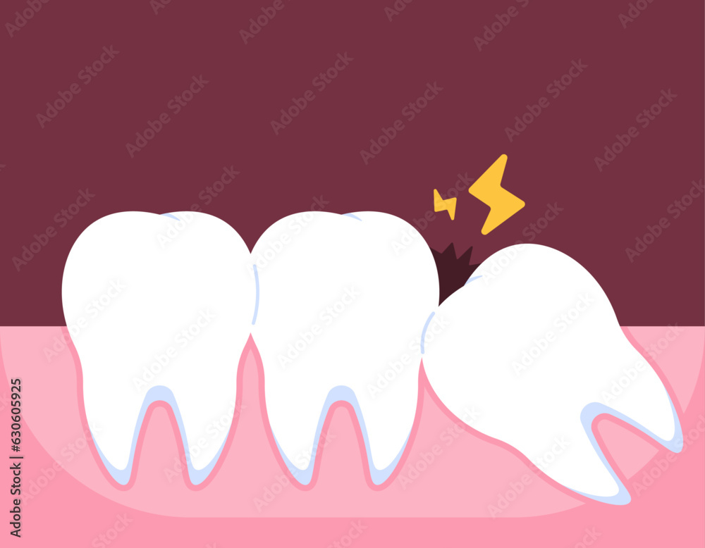 Illustration of a wisdom tooth that is starting to grow. Wisdom teeth ...