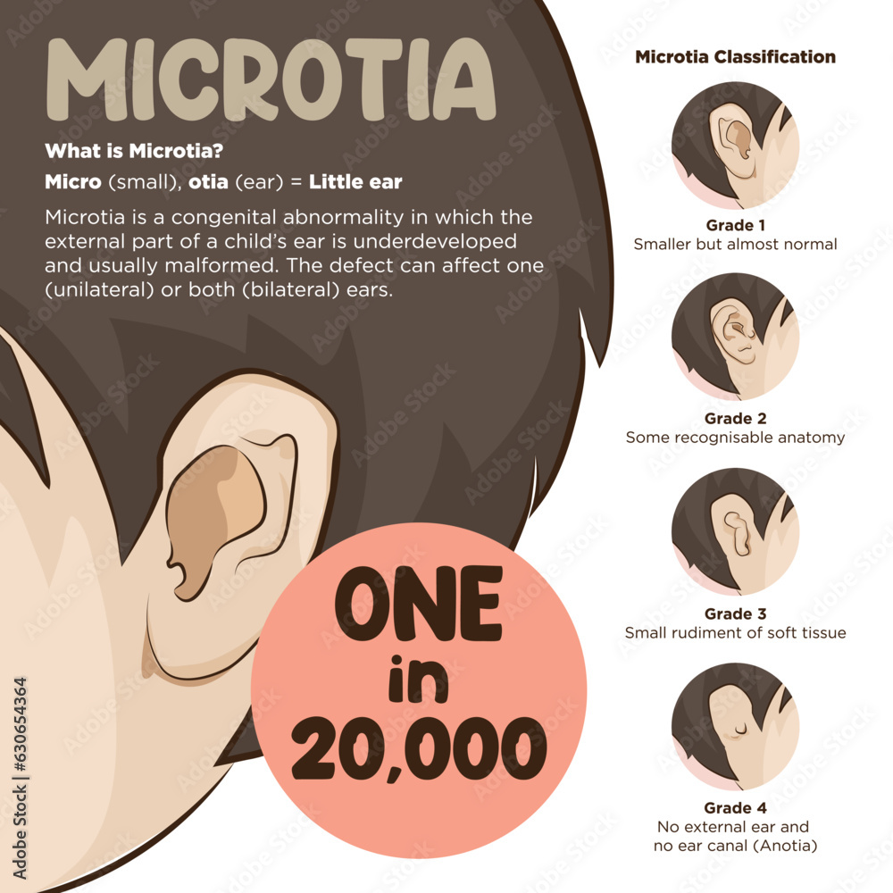 Art vector and infographic of Microtia. Ear birth defect. Awareness ...