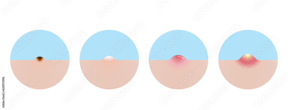 Types of acne vector icon set illustration isolated on white background ...