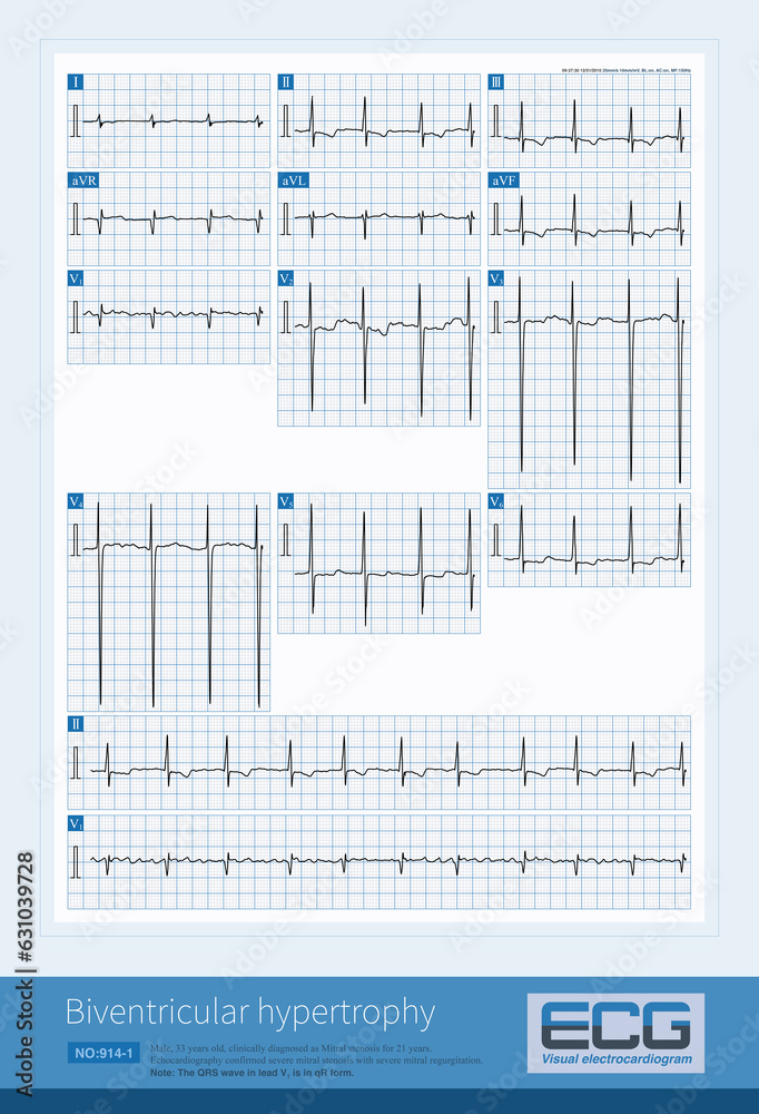 When the QRS wave in the V2-V4 chest lead is biphasic and has an ...