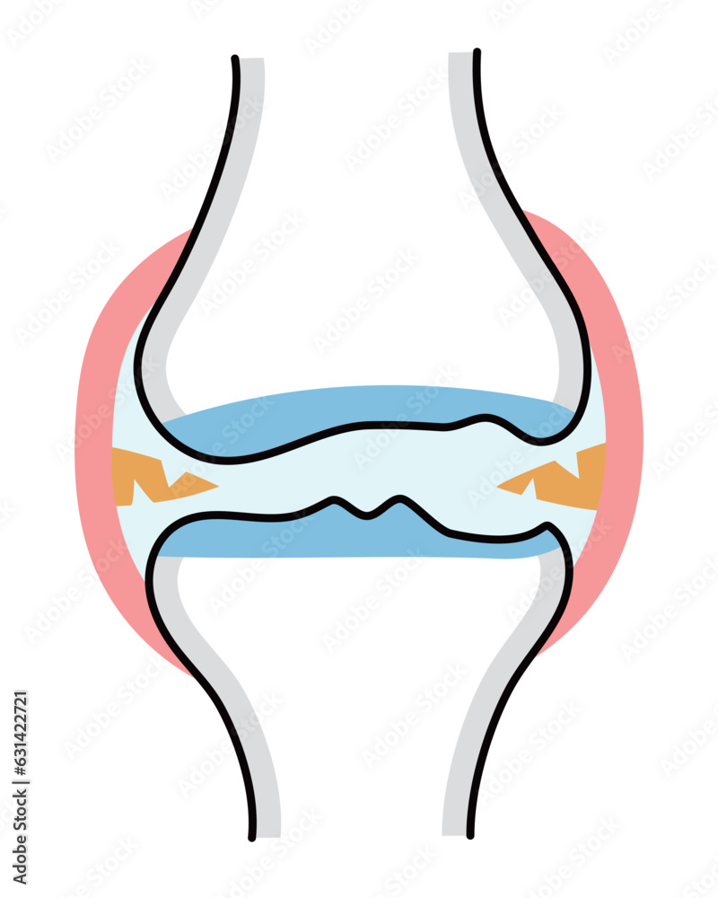 軽症の変形性膝関節症のシンプルなイラスト Stock Vector | Adobe Stock