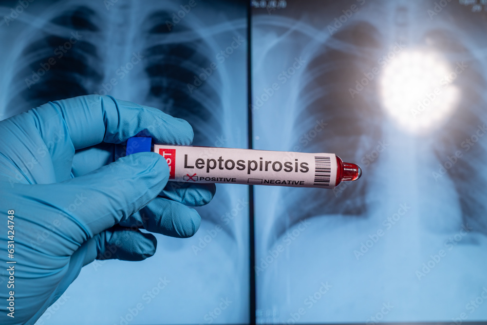Blood collection tubes Leptospirosis test positive results ...