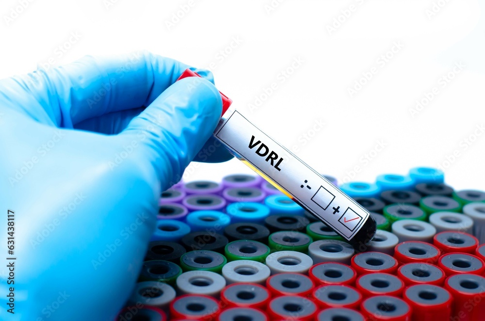 Blood sample of syphilis patient positive test for VDRL. Stock Photo ...