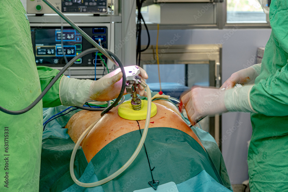 Preparing the patient for endoscopic surgery. Medical team of surgeons ...