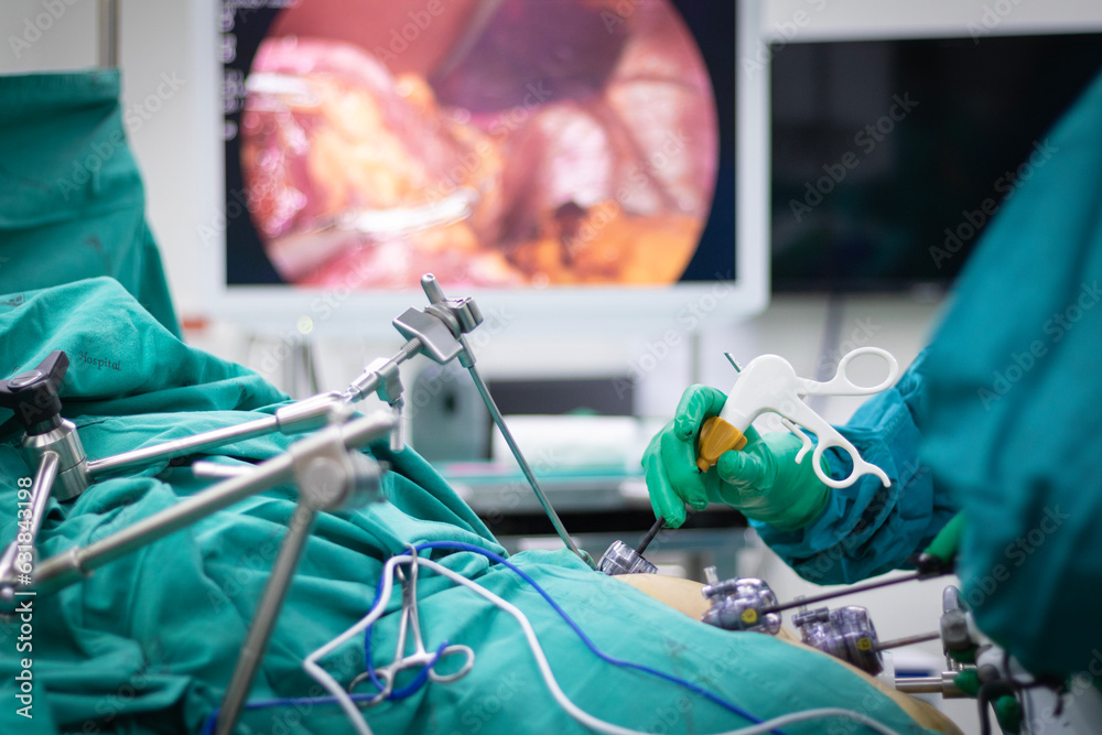 Minimally invasive surgery laparoscopic sleeve gastrectomy Photos ...