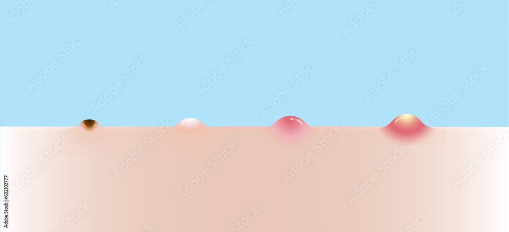 Types of acne vector set illustration isolated on sky blue background ...