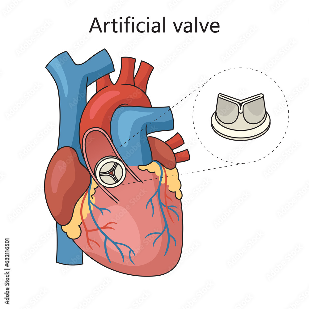 Artificial heart valve in human heart diagram schematic raster ...