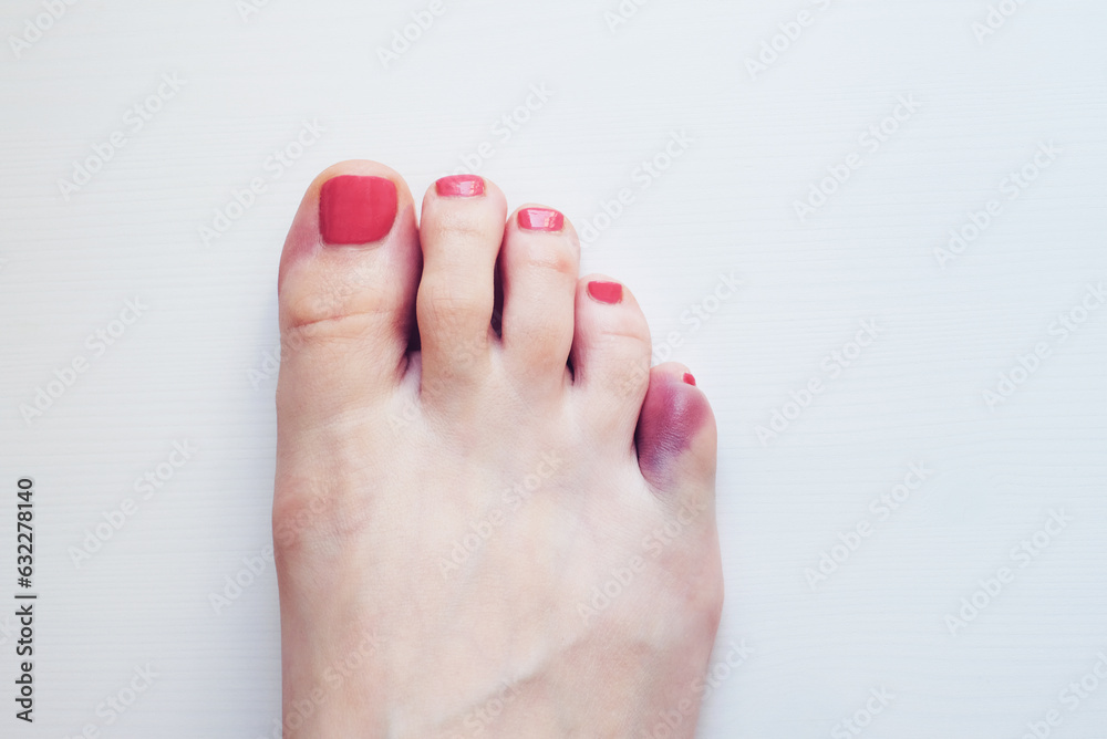 Foot with broken pinky toe caused by forceful impact with furniture ...