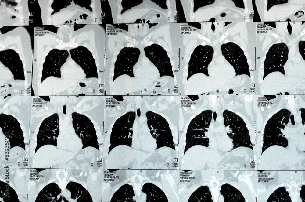 Multi slice CT scan of the chest showing normal study, normal ...